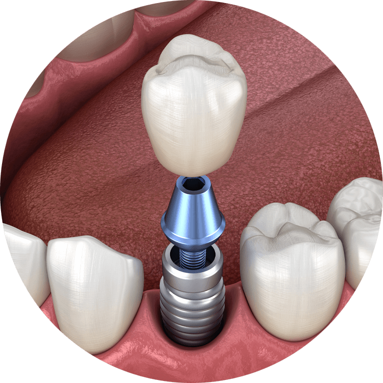 Individual Implants - Camtu Dental