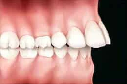 Invisalign Orthodontic - Camtu Dental